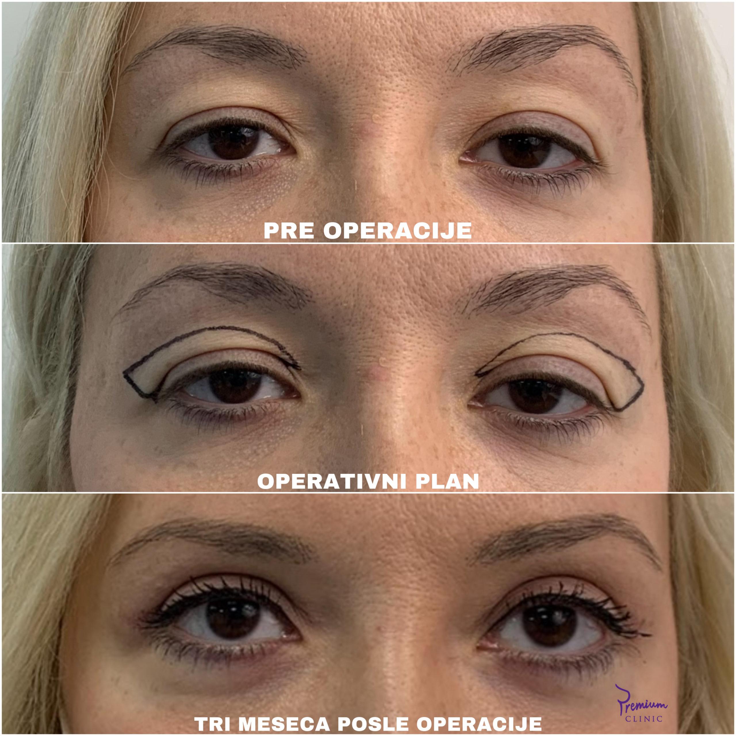 Operacija kapaka - Premium Clinic Beograd
