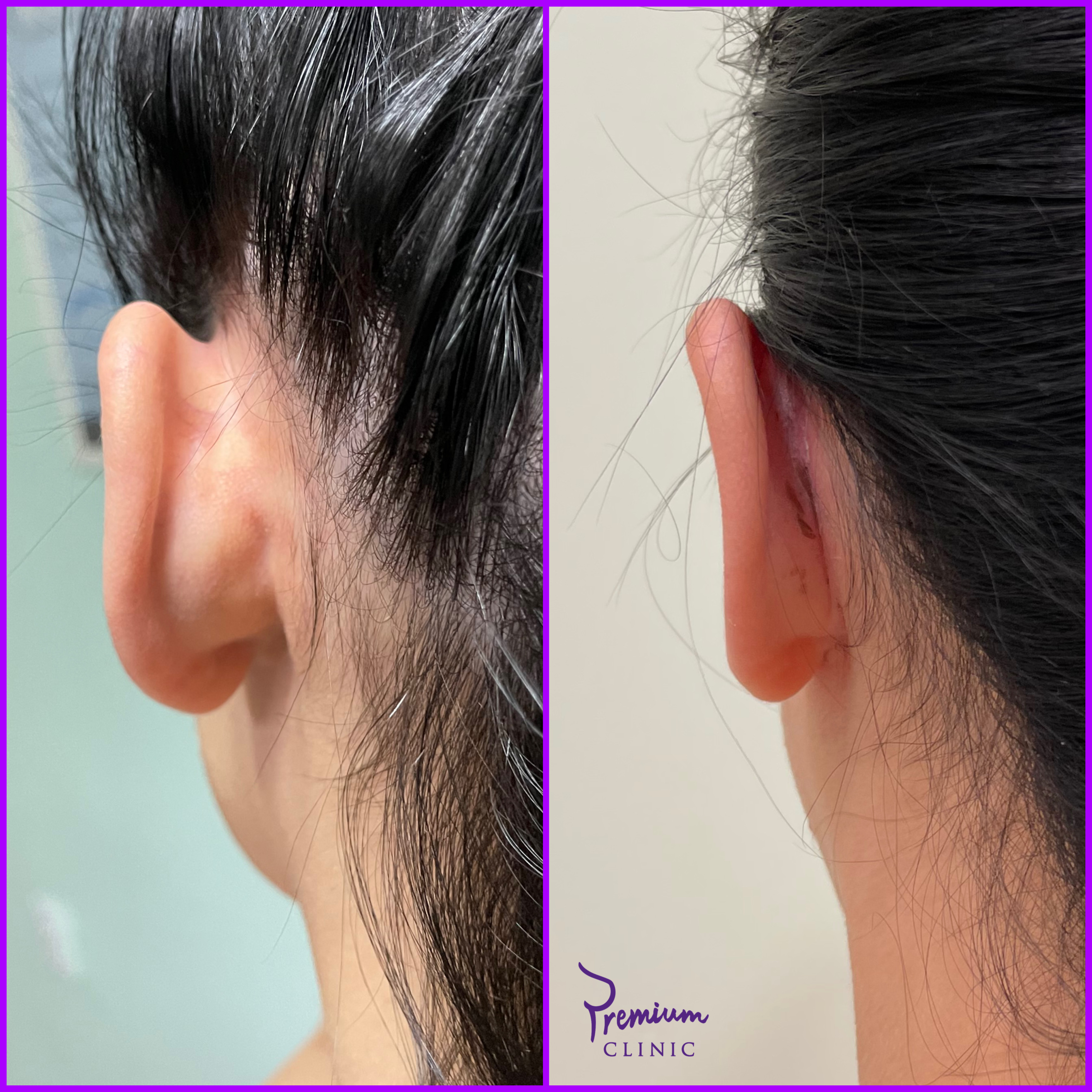 Operacija ušiju - Premium Clinic Beograd