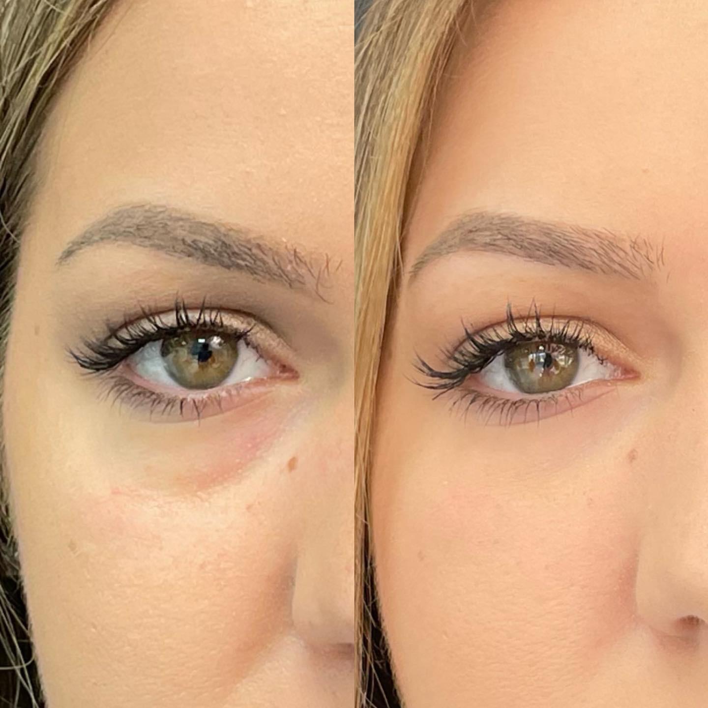 Korekcija podočnjaka - Premium Clinic Beograd