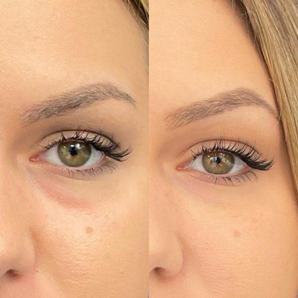 Korekcija podočnjaka - Premium Clinic Beograd