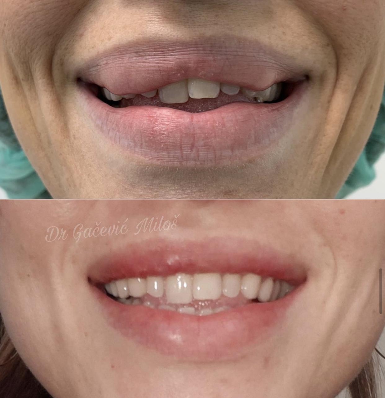 Operacija usana - Premium Clinic Beograd