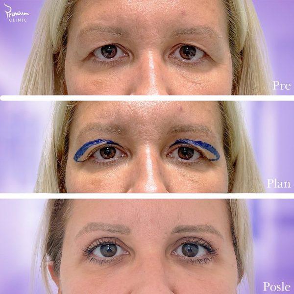 Operacija očnih kapaka: procedura za sve uzraste - Premium Clinic Beograd