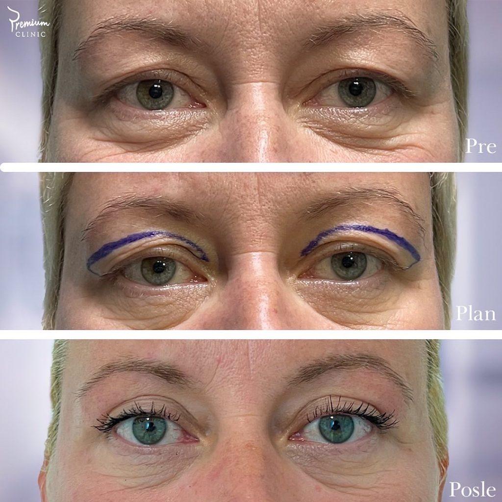 Operacija kapaka - Premium Clinic Beograd