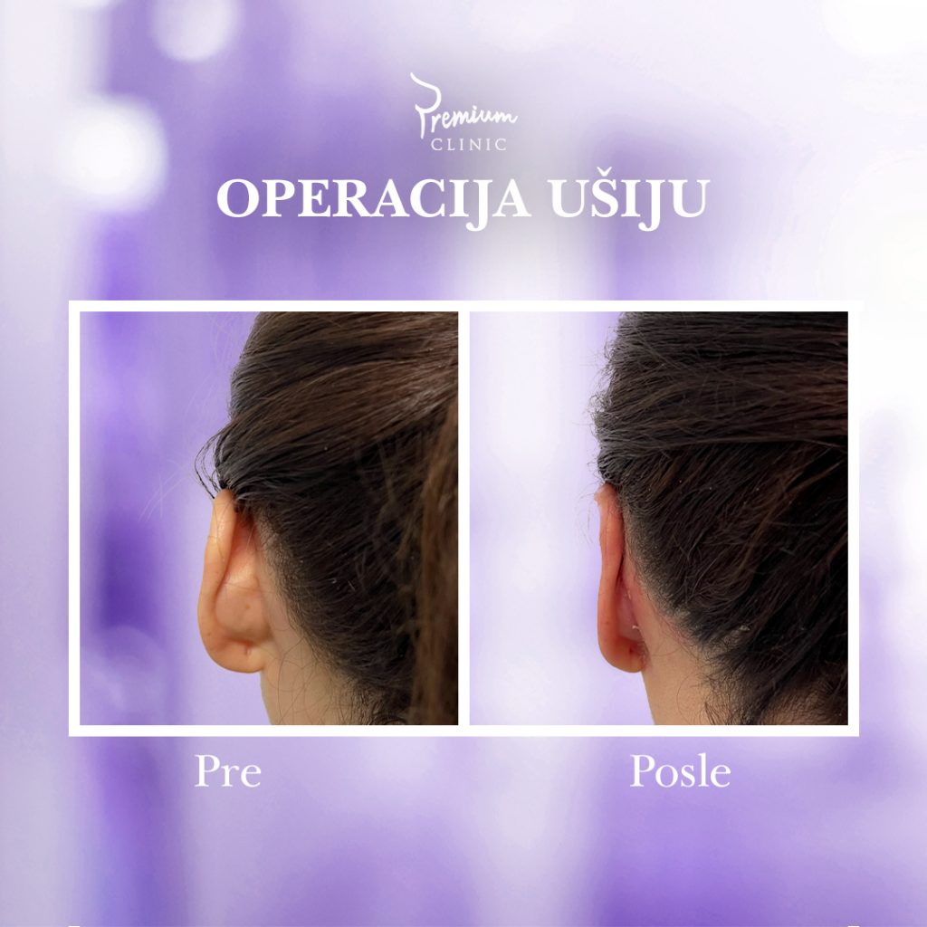 Operacija usiju 2 - Premium Clinic Beograd