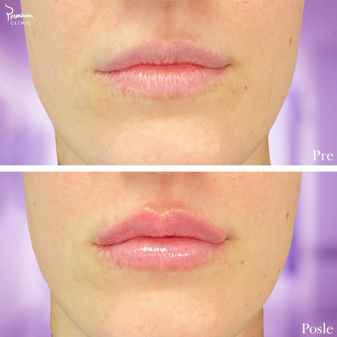 Operacija usana - Premium Clinic Beograd