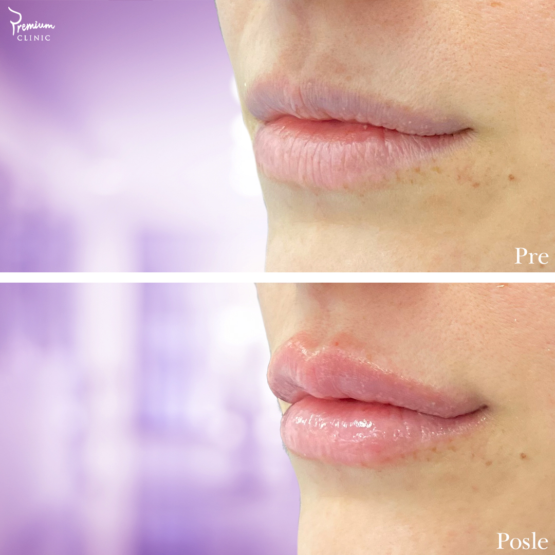 Operacija usana - Premium Clinic Beograd