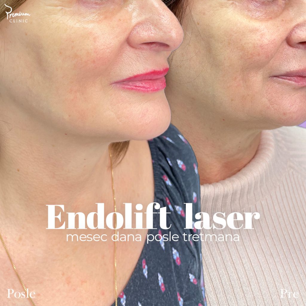 Endolift laser - Premium Clinic Beograd